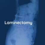 Foraminotomy